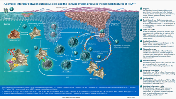 Pathophysiology of Psoriasis | Engaging Psoriatic Disease
